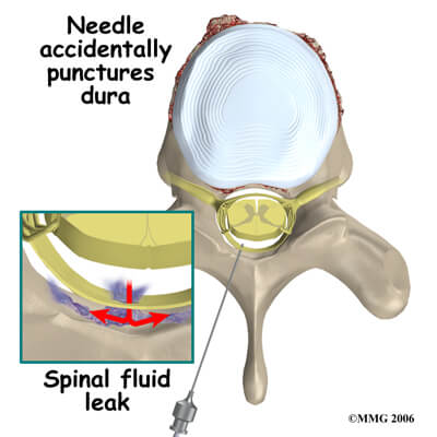 Comprehensive Guide to Epidural Steroid Injections | Physiocare ...